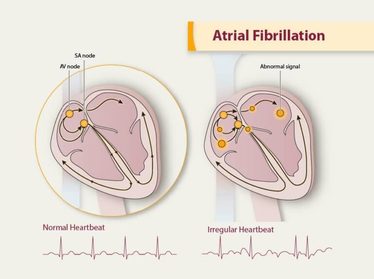 Atrial Fibrillation Awareness Month | Hospice At Your Side